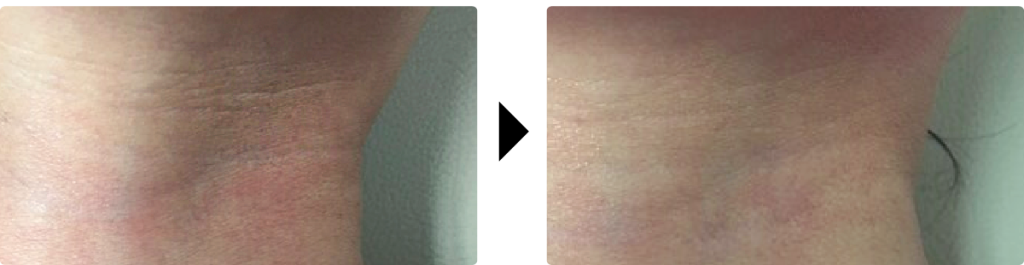 Liftera Cool 冰爽無針埋線 香港官網