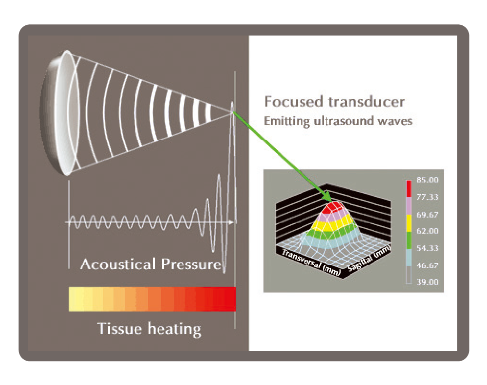 2025最新Liftera Cool 冰爽無針埋線 香港官網