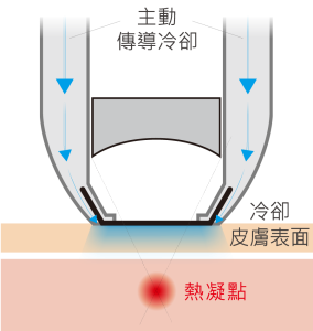 2025最新Liftera Cool 冰爽無針埋線 香港官網