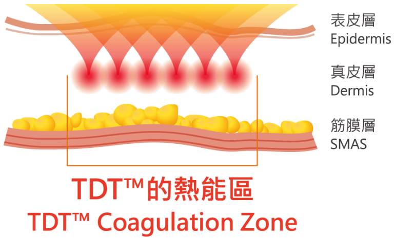 2025最新Liftera Cool 冰爽無針埋線 香港官網